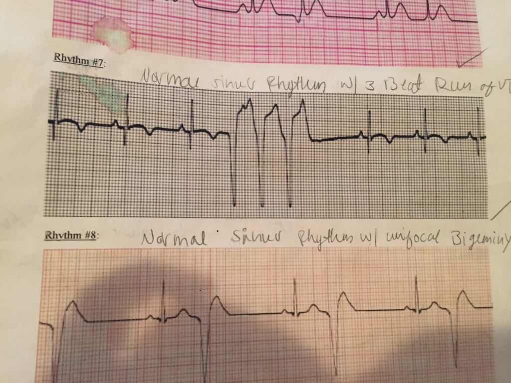 Solved ECG #7 Normal Sinus Rhythm with a multifocal 3 beat | Chegg.com