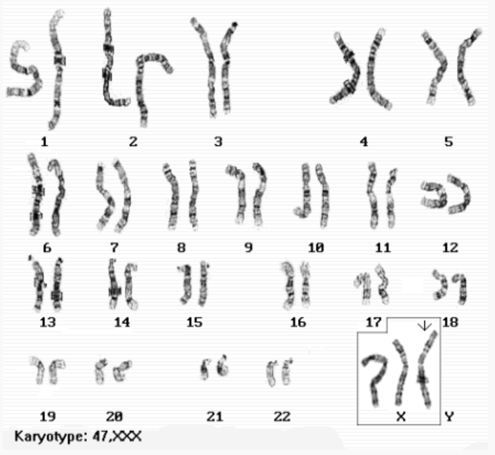 Nondisjunction Karyotype