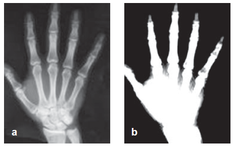 Solved Two X-ray images of the hand are shown in . One | Chegg.com