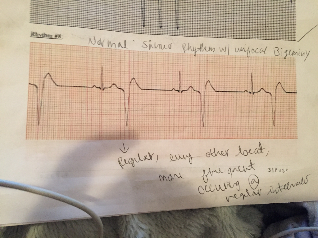 Solved Normal Sinus Rhythm with unifocal bigeminy Does | Chegg.com