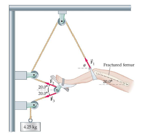 Solved Doctors often use the Russell Traction System to | Chegg.com
