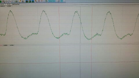 Solved is this second or third degree heart block (frog | Chegg.com