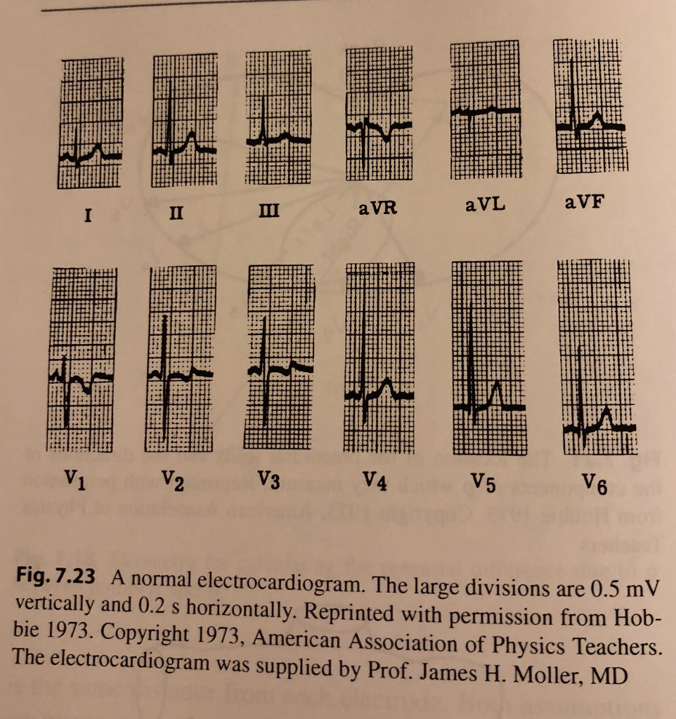 Solved Problem 26. Consider Lead II of the normal ECG in | Chegg.com