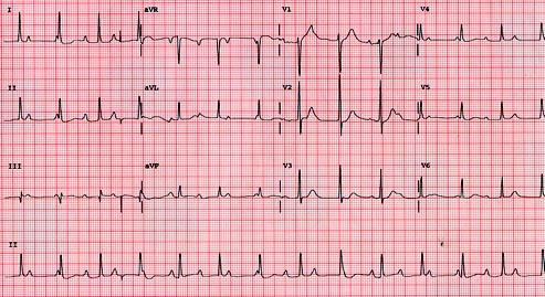 Solved interpret the ekg. Pathology?: Heart Rate: | Chegg.com