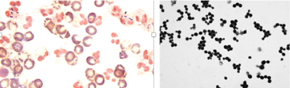 Solved You have 2 patients with symptoms of meningitis. You | Chegg.com