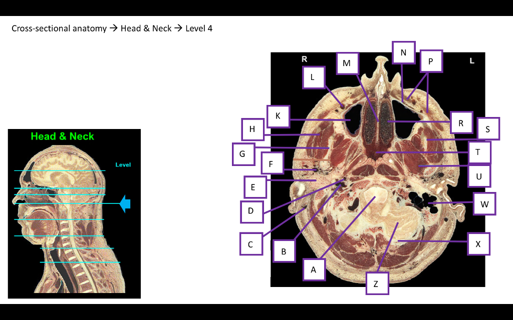 Solved Cross-sectional anatomy → Head & Neck-) Level 4 Head | Chegg.com