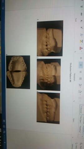 Solved Occlusion using Angles Classification for Rt. Canine | Chegg.com