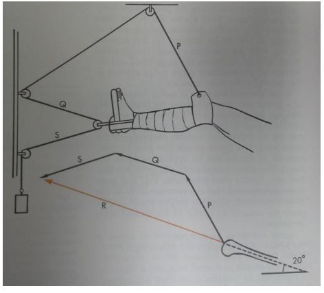 Solved Draw the free body diagram for Russell traction for | Chegg.com
