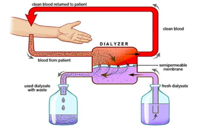 Solved Dialysis is a process where a person with | Chegg.com