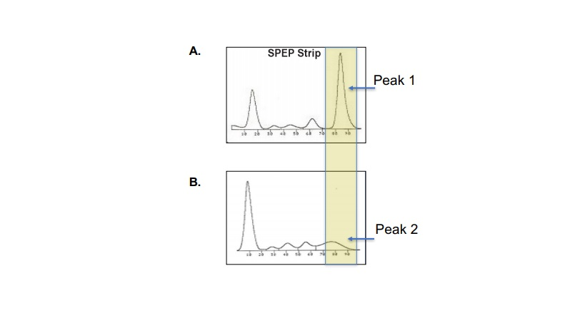 Solved The serum protein electrophoresis (SPEP) is a simple | Chegg.com