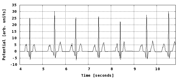 Solved The plot shows an electrocardiogram (EKG) of a | Chegg.com