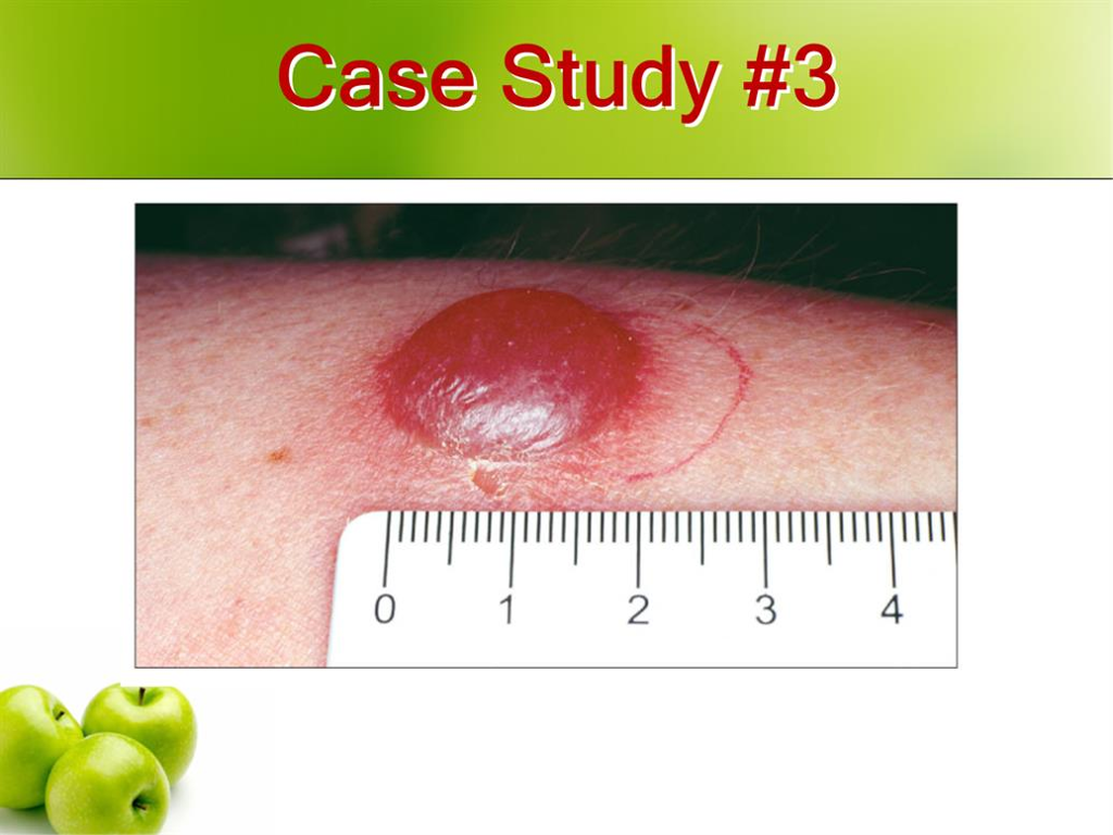 Solved Case Study Help! Microbiology A 42 year old male | Chegg.com