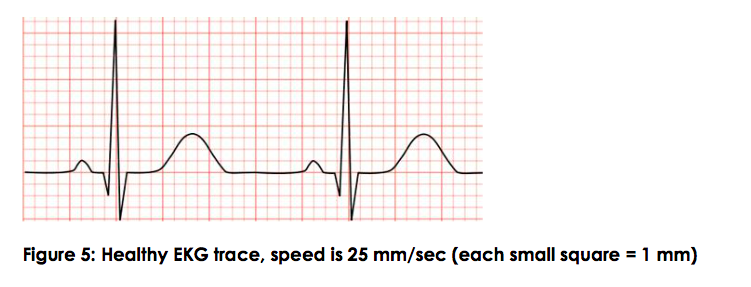 Solved EKG ANALYSIS HELP While I understand the concept of | Chegg.com