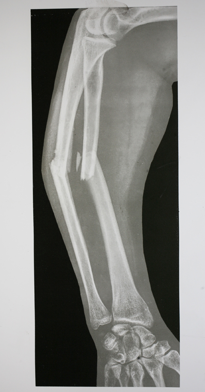 Human Broken Arm X Ray