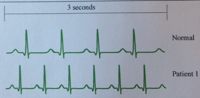 Solved Stroke Volume Normal 70 Ml Stroke Volume Patient 4294