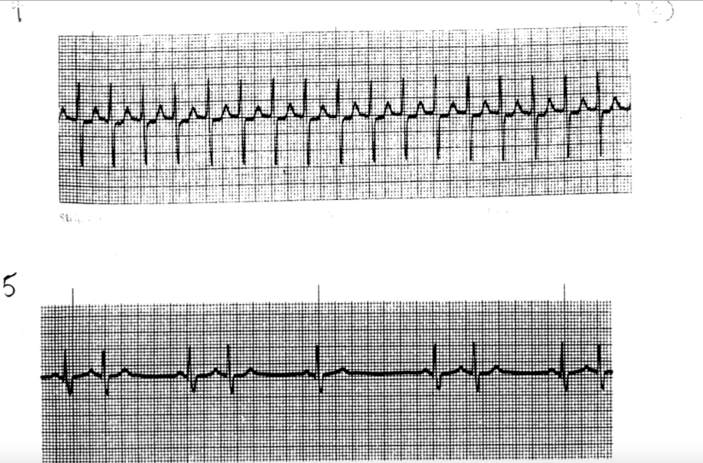 IDENTIFY each one of the rhythms using the process of | Chegg.com